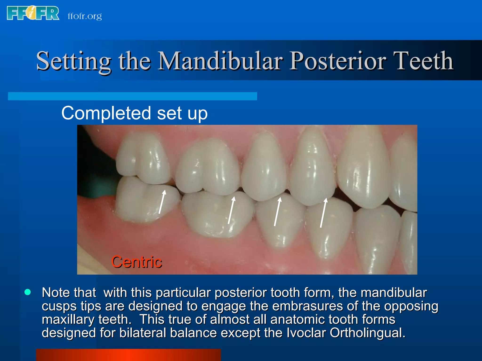 17.occlusal schemes anatomic and semiamatomic occlusion | PPT