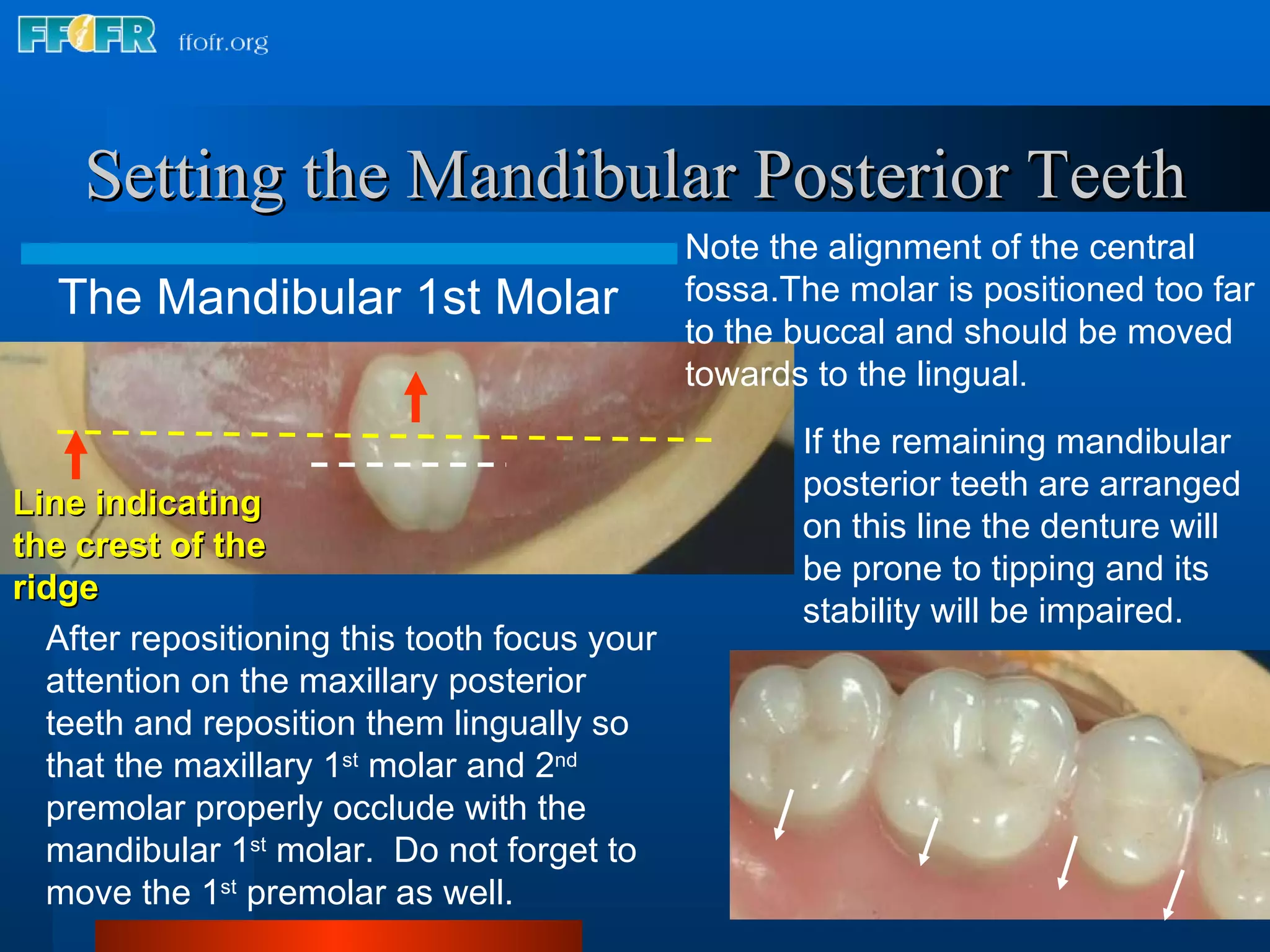 17.occlusal schemes anatomic and semiamatomic occlusion | PPT