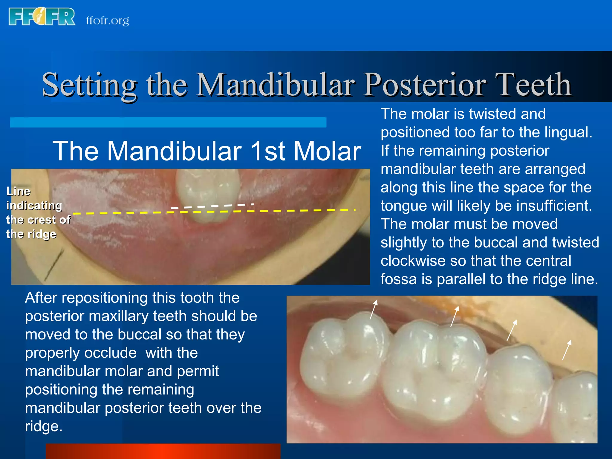 17.occlusal schemes anatomic and semiamatomic occlusion | PPT