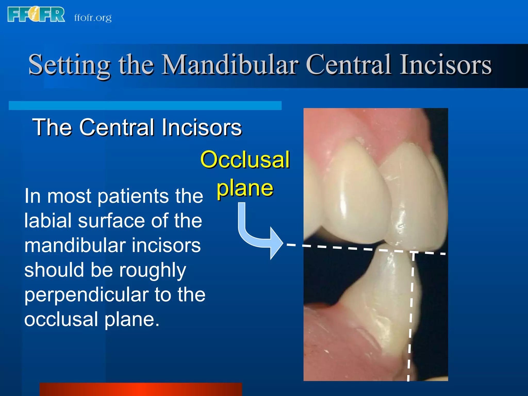 17.occlusal schemes anatomic and semiamatomic occlusion | PPT
