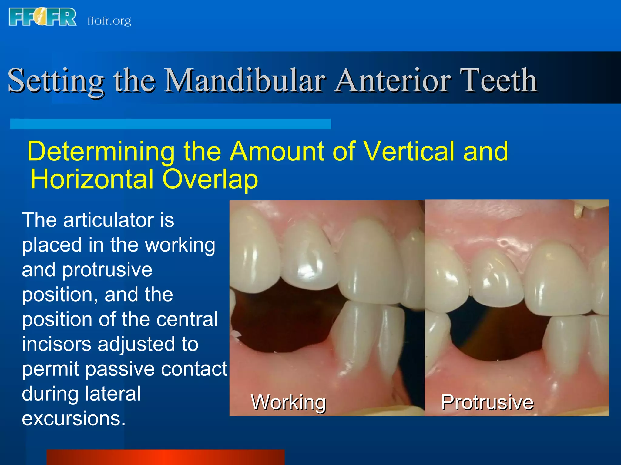 17.occlusal schemes anatomic and semiamatomic occlusion | PPT