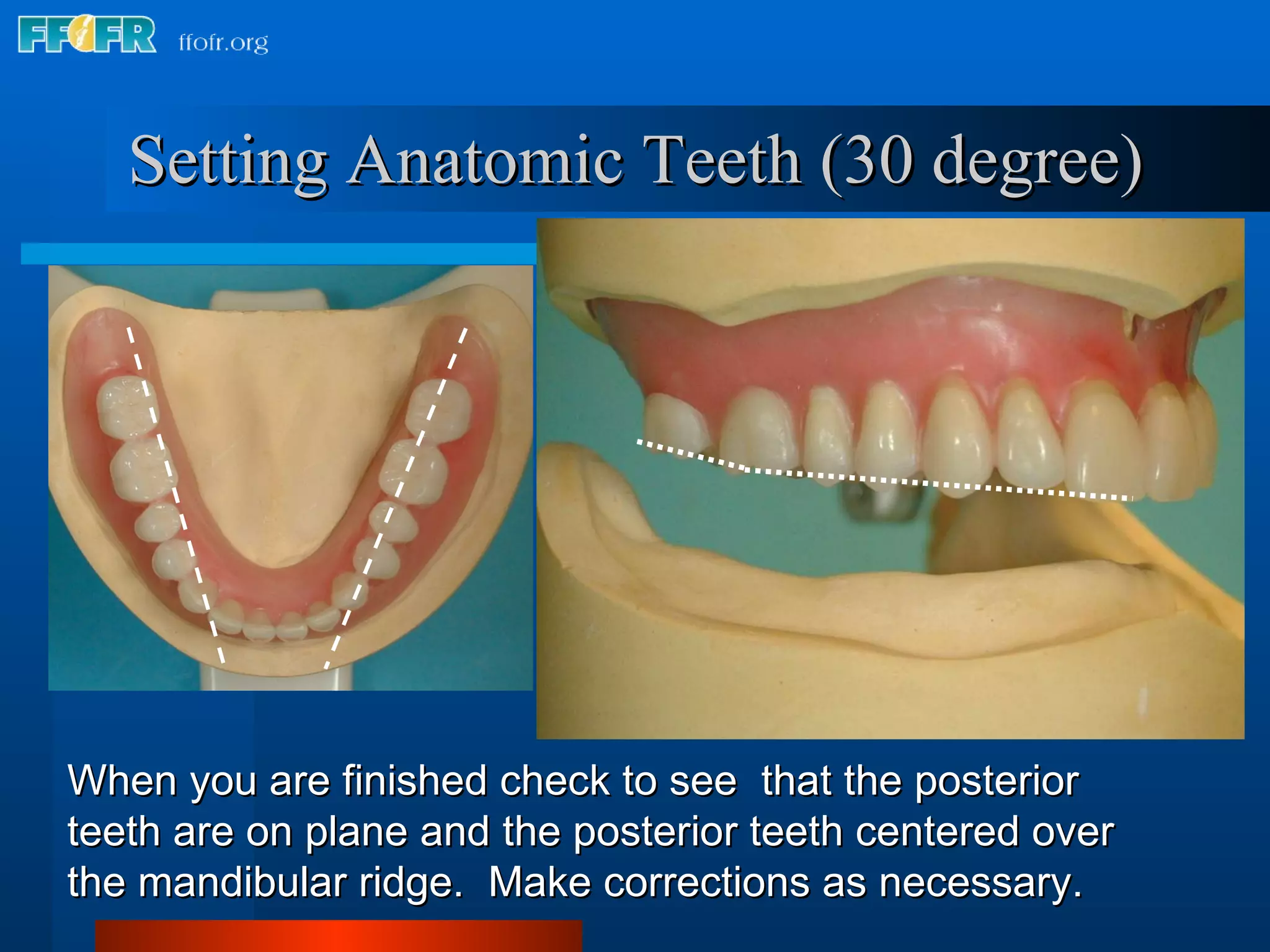 17.occlusal schemes anatomic and semiamatomic occlusion | PPT