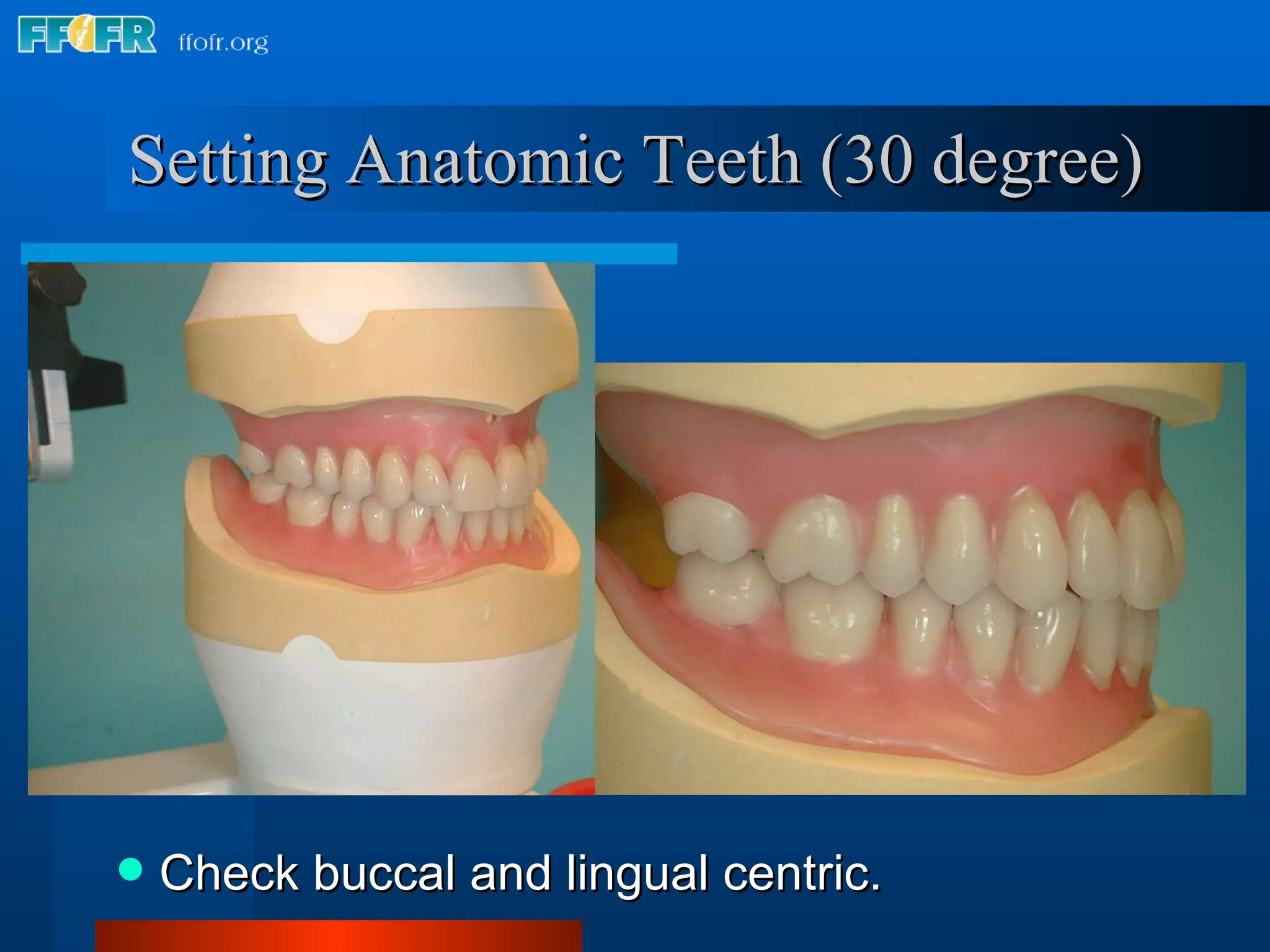 17.occlusal schemes anatomic and semiamatomic occlusion | PPT