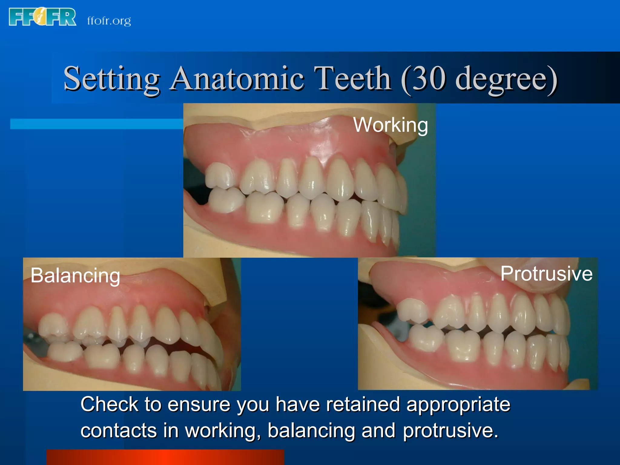 17.occlusal schemes anatomic and semiamatomic occlusion | PPT