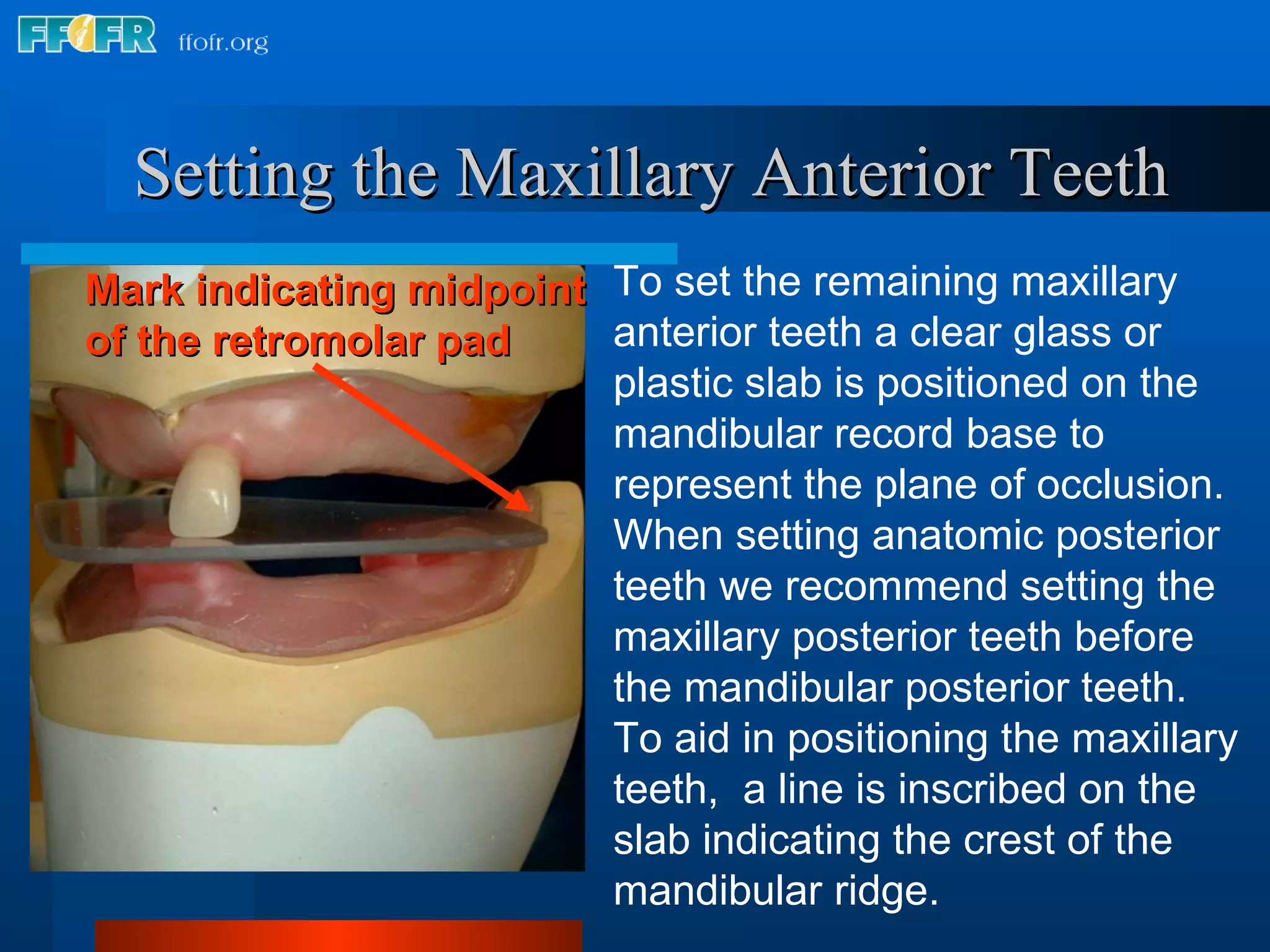 17.occlusal schemes anatomic and semiamatomic occlusion | PPT