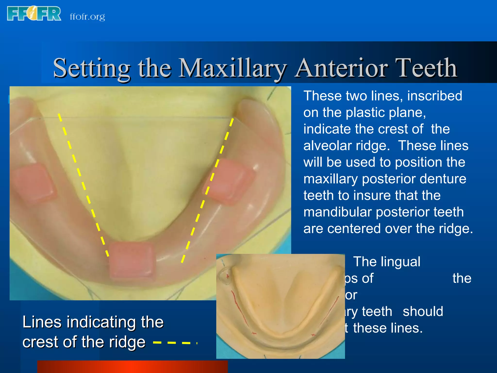17.occlusal schemes anatomic and semiamatomic occlusion | PPT