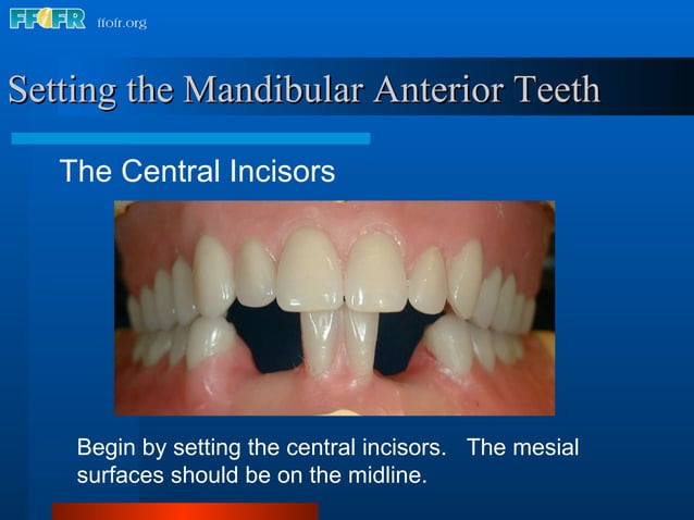 17.occlusal schemes anatomic and semiamatomic occlusion | PPT