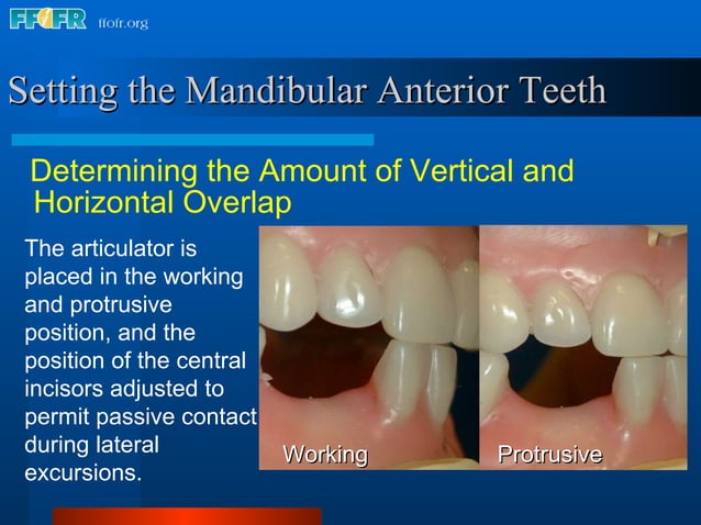 17.occlusal schemes anatomic and semiamatomic occlusion | PPT