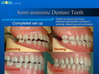 17.occlusal schemes anatomic and semiamatomic occlusion | PPT