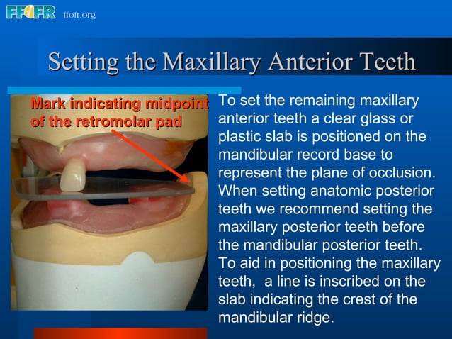 17.occlusal schemes anatomic and semiamatomic occlusion | PPT