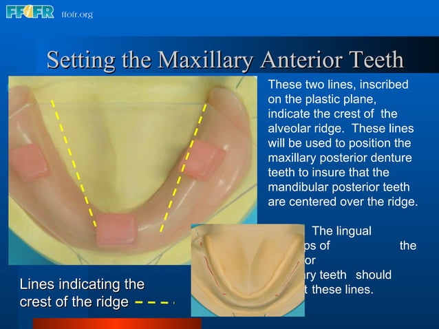 17.occlusal schemes anatomic and semiamatomic occlusion | PPT