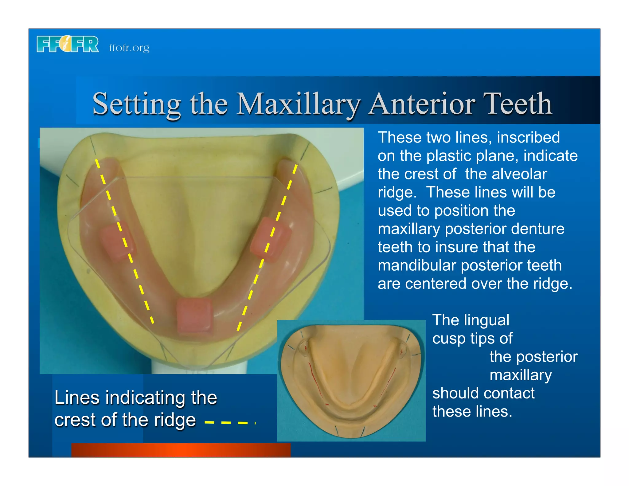 17.occlusal schemes anatomic and semiamatomic occlusion | PDF
