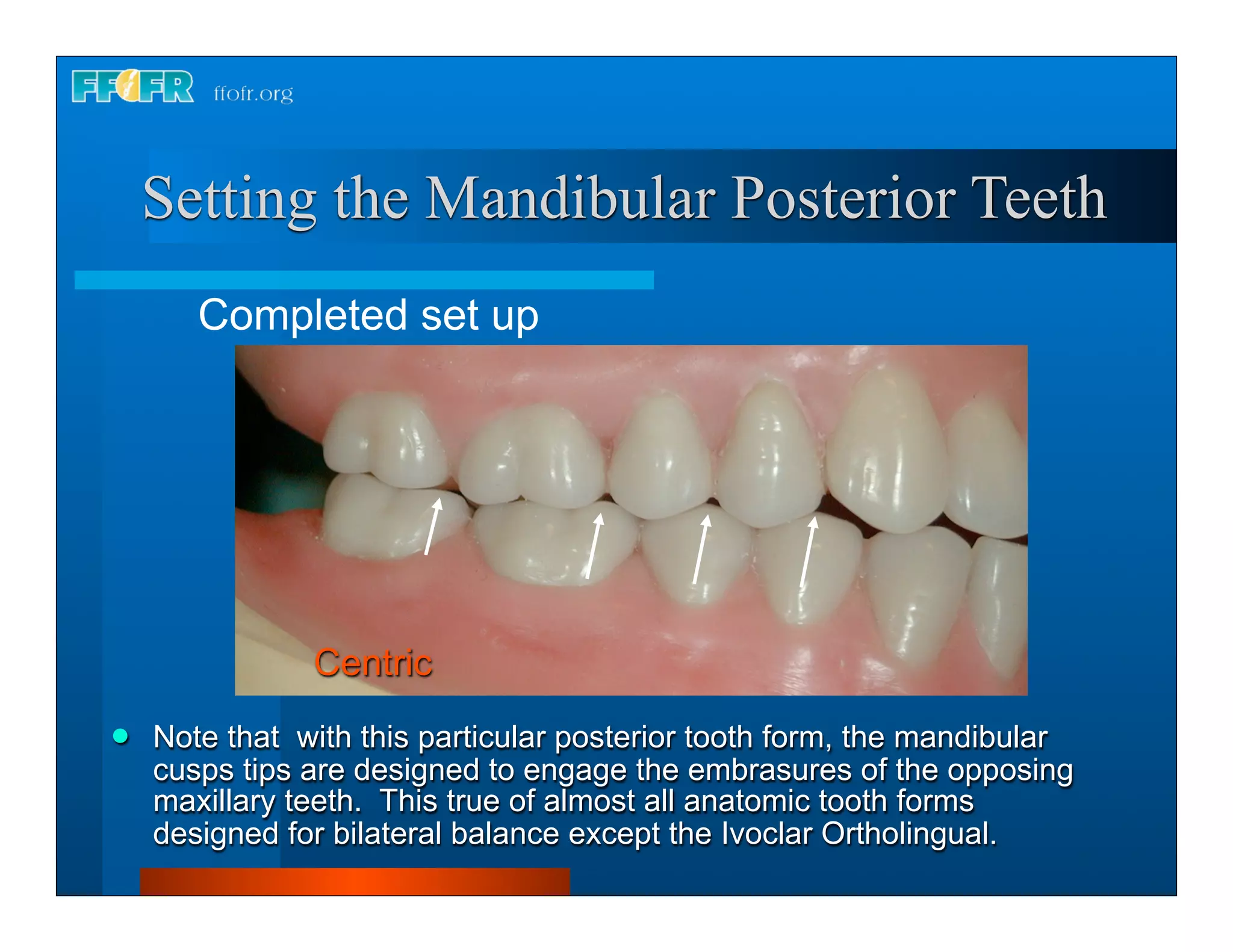 17.occlusal schemes anatomic and semiamatomic occlusion | PDF