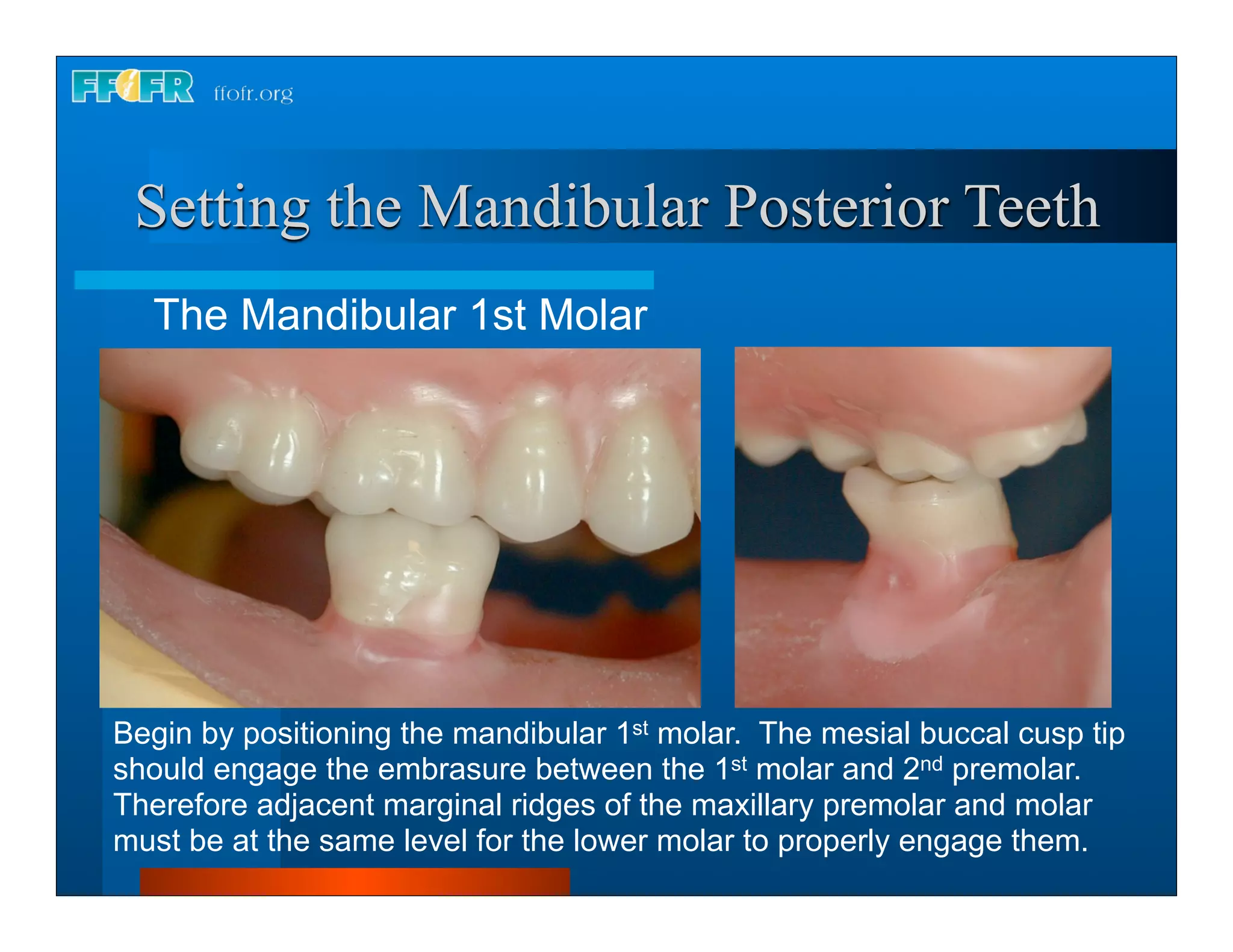 17.occlusal schemes anatomic and semiamatomic occlusion | PDF