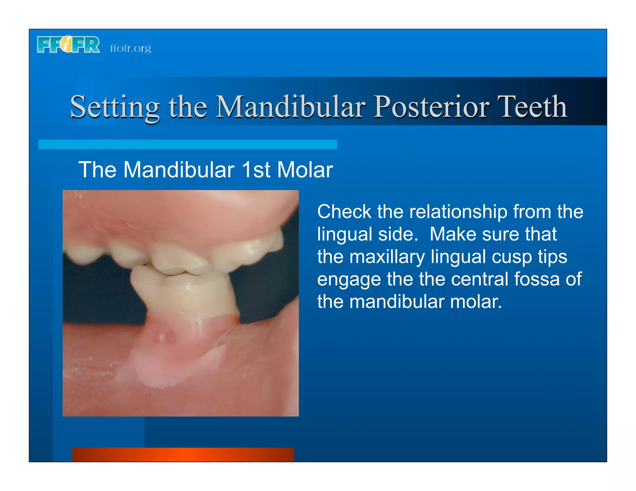 17.occlusal schemes anatomic and semiamatomic occlusion | PDF