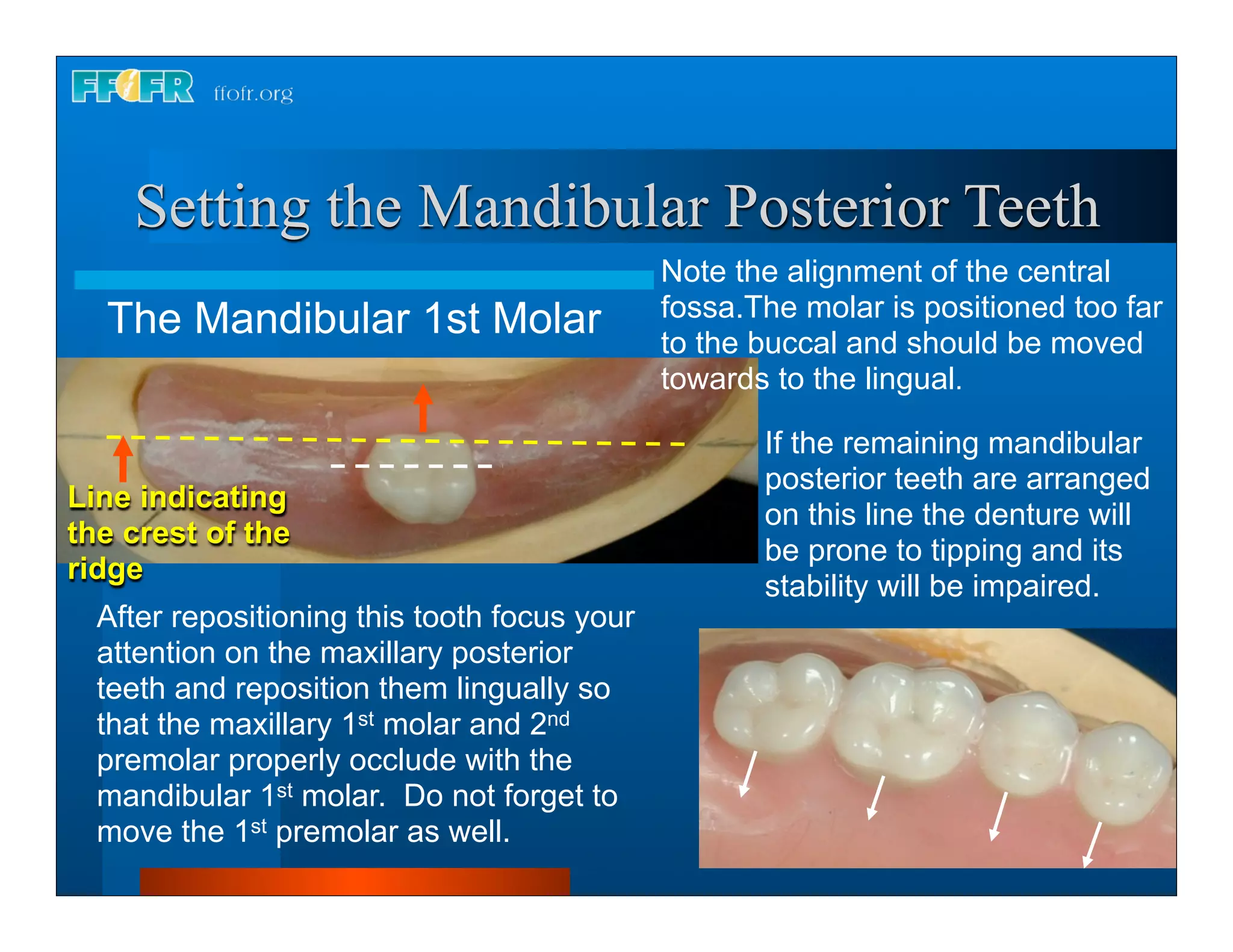 17.occlusal schemes anatomic and semiamatomic occlusion | PDF