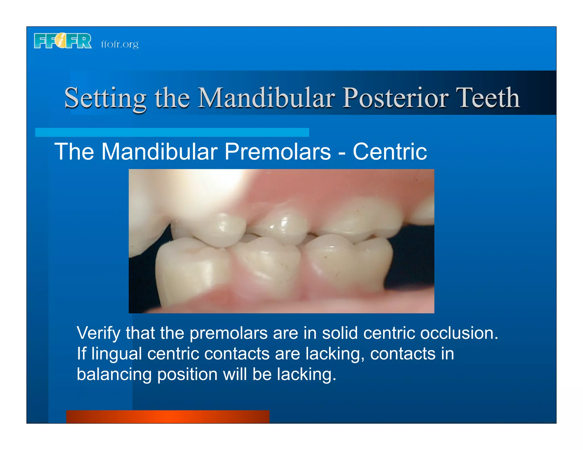 17.occlusal schemes anatomic and semiamatomic occlusion | PDF