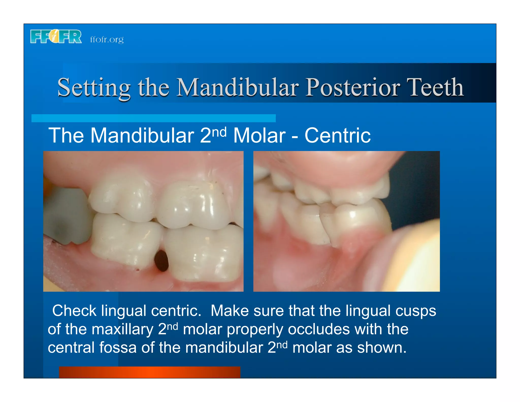 17.occlusal schemes anatomic and semiamatomic occlusion | PDF