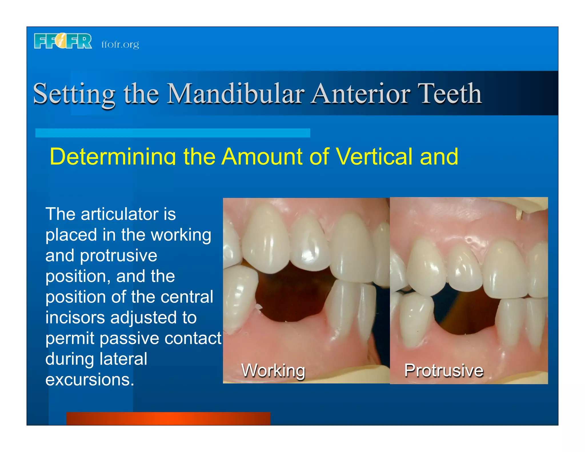17.occlusal schemes anatomic and semiamatomic occlusion | PDF