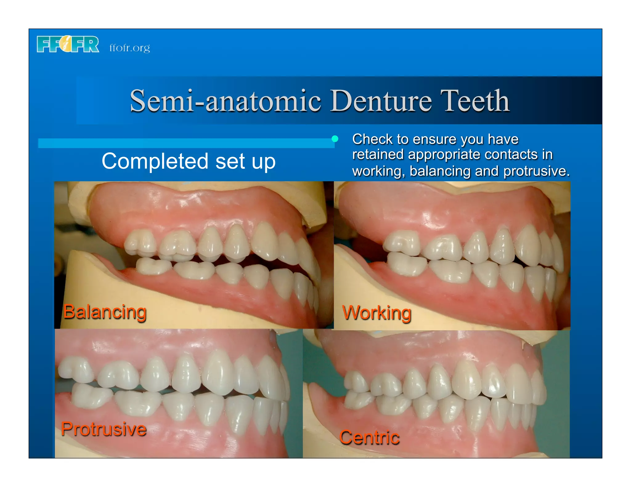 17.occlusal schemes anatomic and semiamatomic occlusion | PDF