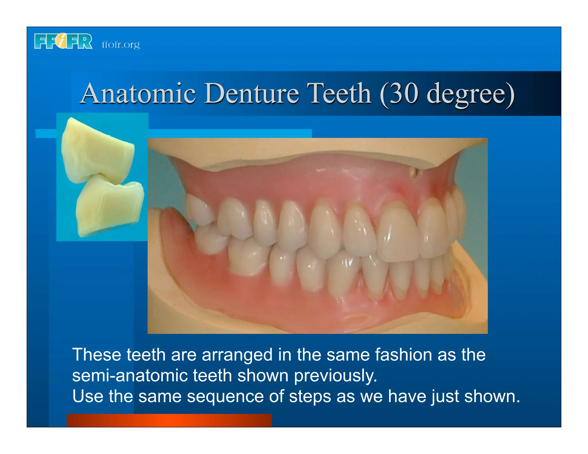 17.occlusal schemes anatomic and semiamatomic occlusion | PDF