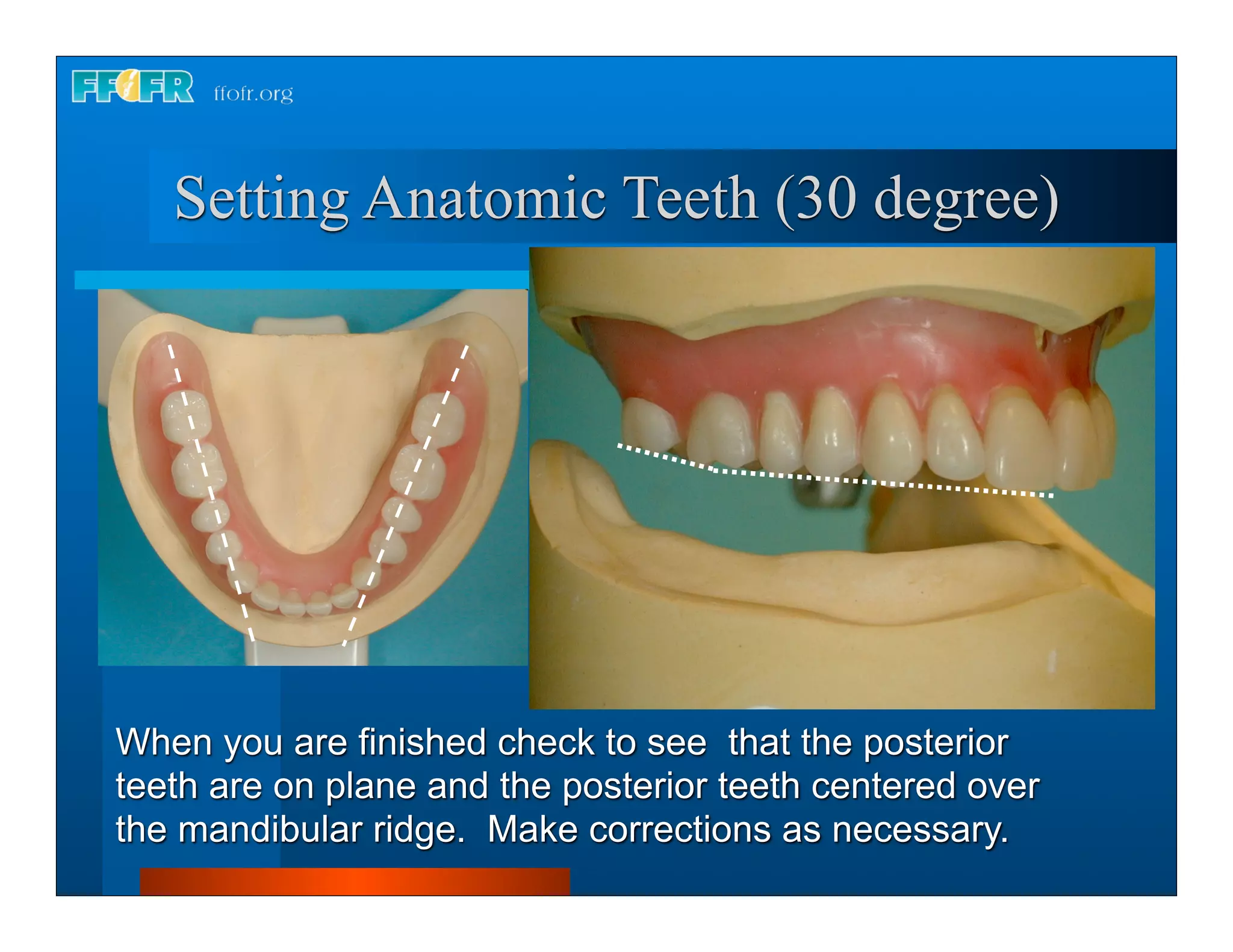 17.occlusal schemes anatomic and semiamatomic occlusion | PDF