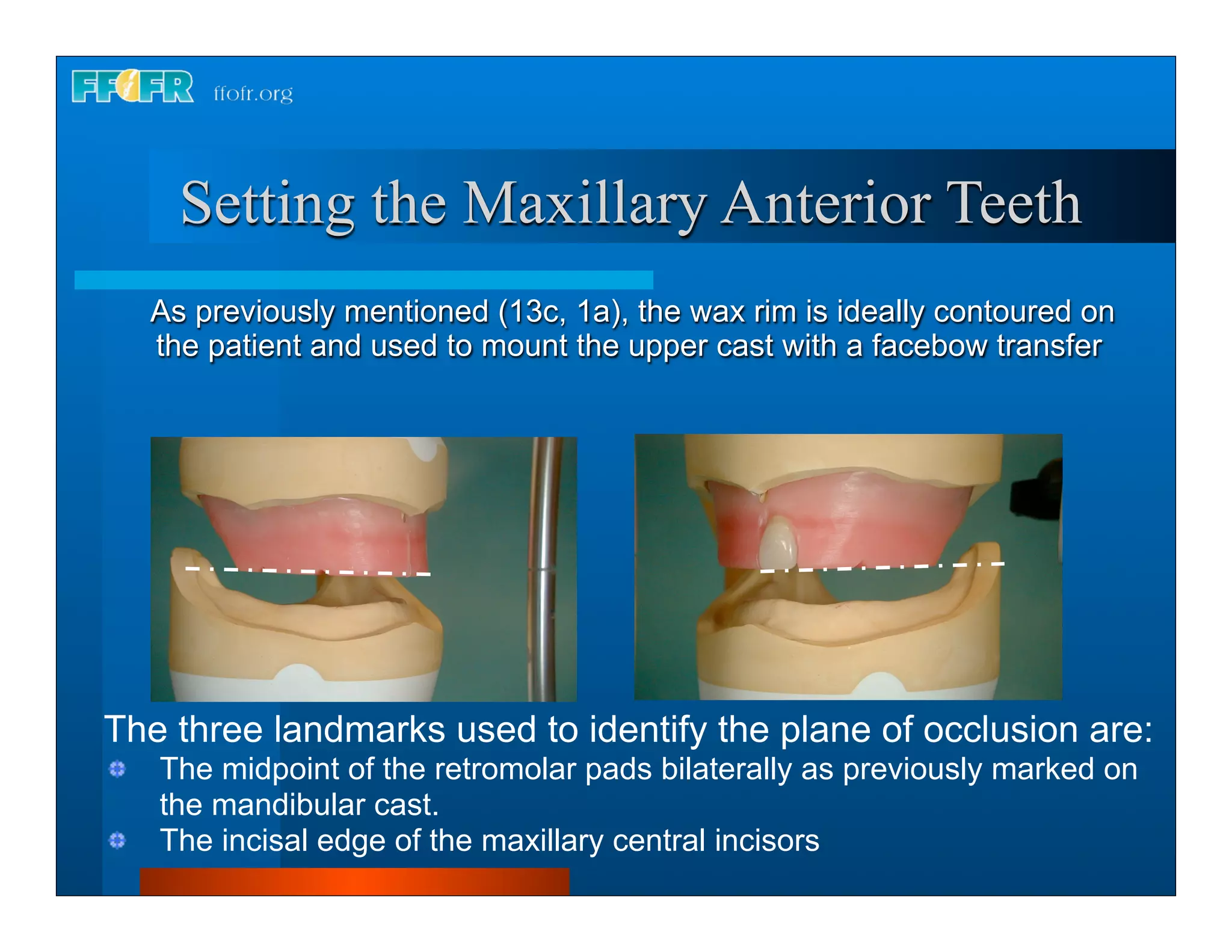 17.occlusal schemes anatomic and semiamatomic occlusion | PDF