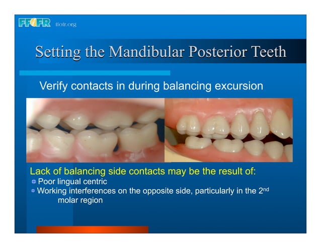 17.occlusal schemes anatomic and semiamatomic occlusion | PDF | Dental ...