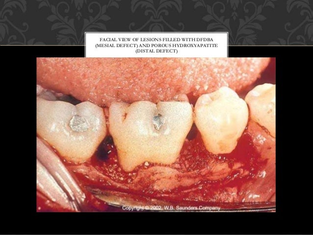periodontal regenerative procedures