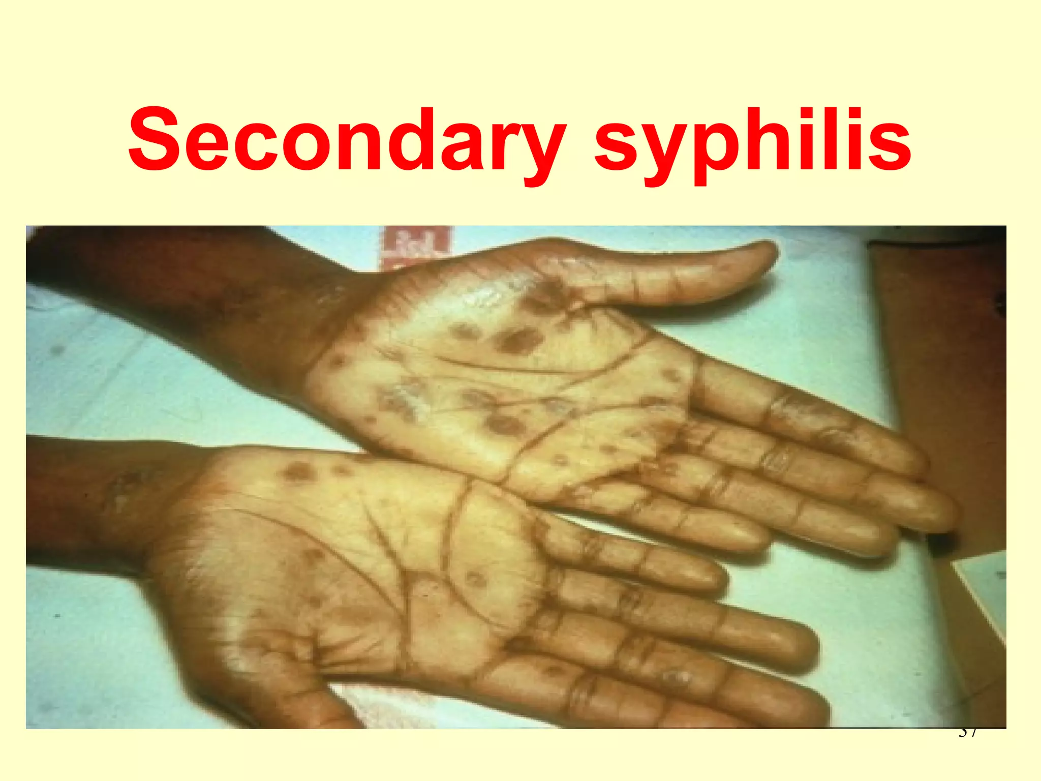 17 spirochetes | PPT