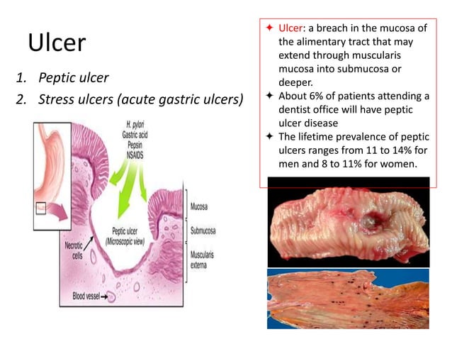 peptic ulcer management and Treatment ppt | PPT