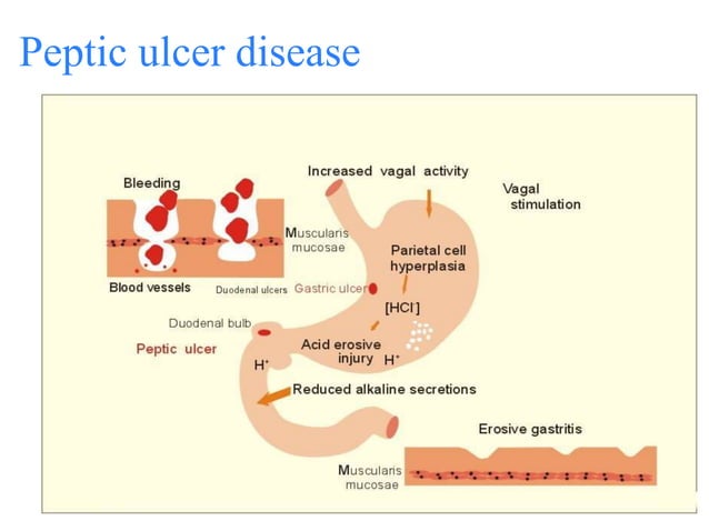 peptic ulcer management and Treatment ppt | PPT
