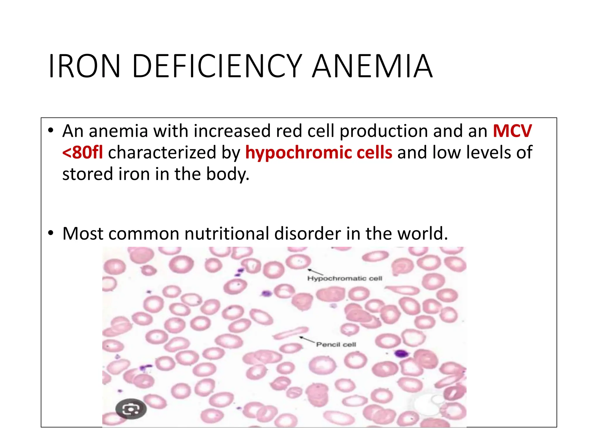 Iron Deficiency Anemia And Classification of Anaemia | PPTX
