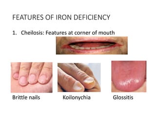 Iron Deficiency Anemia And Classification of Anaemia | PPTX