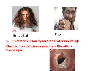 Iron Deficiency Anemia And Classification of Anaemia | PPTX
