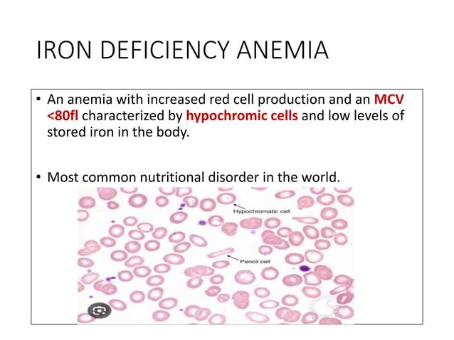 Iron Deficiency Anemia And Classification of Anaemia | PPTX | Blood ...