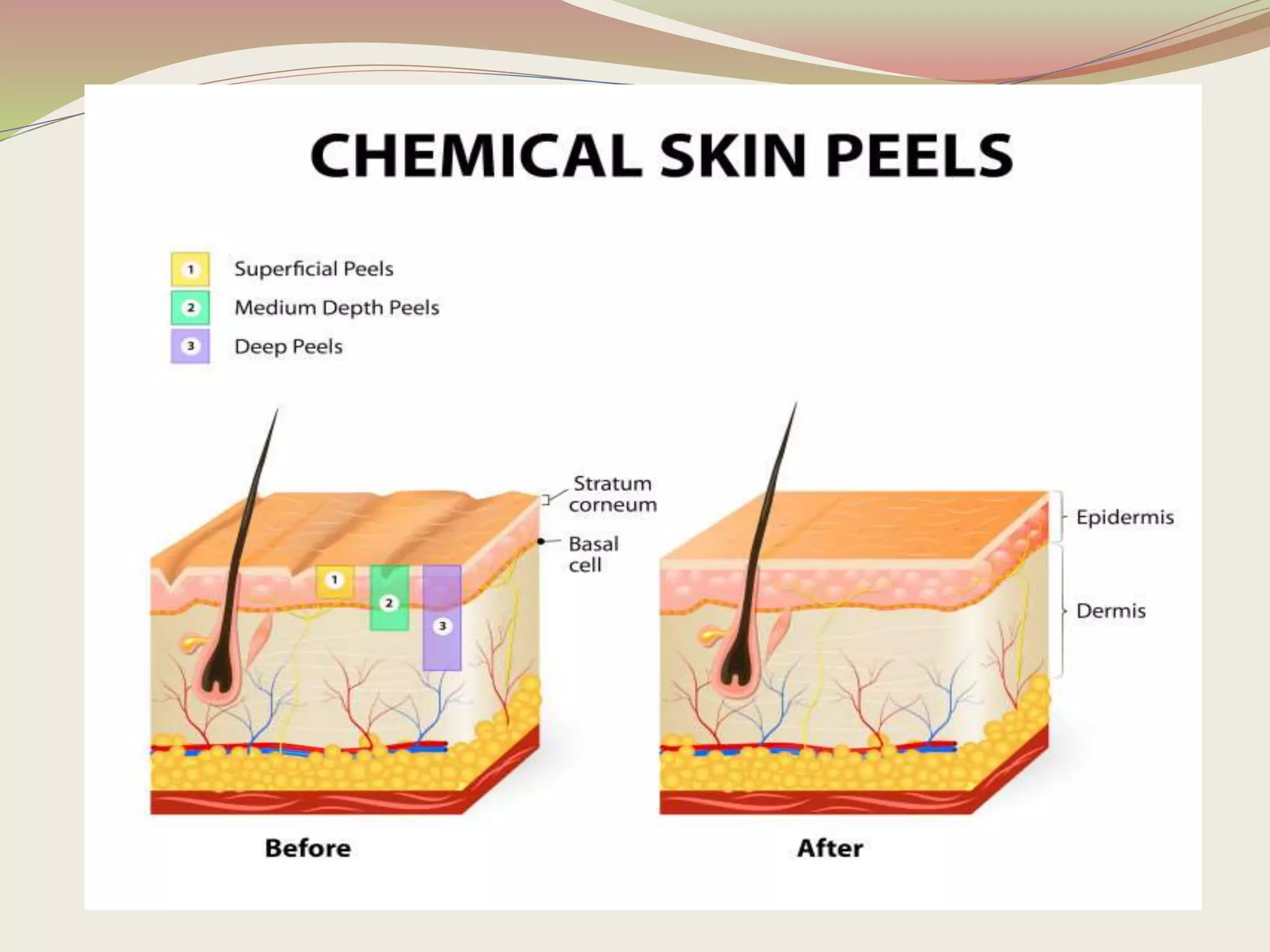 chemical peels.ppt