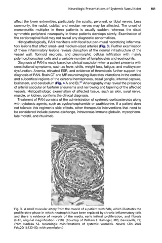 171 neurologic presentations of systemic vasculitides | PDF