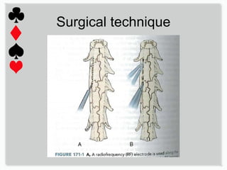 171&Sch ch130 Dorsal root entry zone lesion (DREZ) | PPT