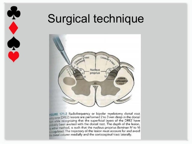 171&Sch ch130 Dorsal root entry zone lesion (DREZ)