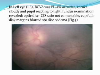 Mucopolysccharidoses : A Rare Cause For Bilateral Cloudy Cornea. | PPTX