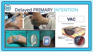 Wound care management (perawatan luka modern).pptx