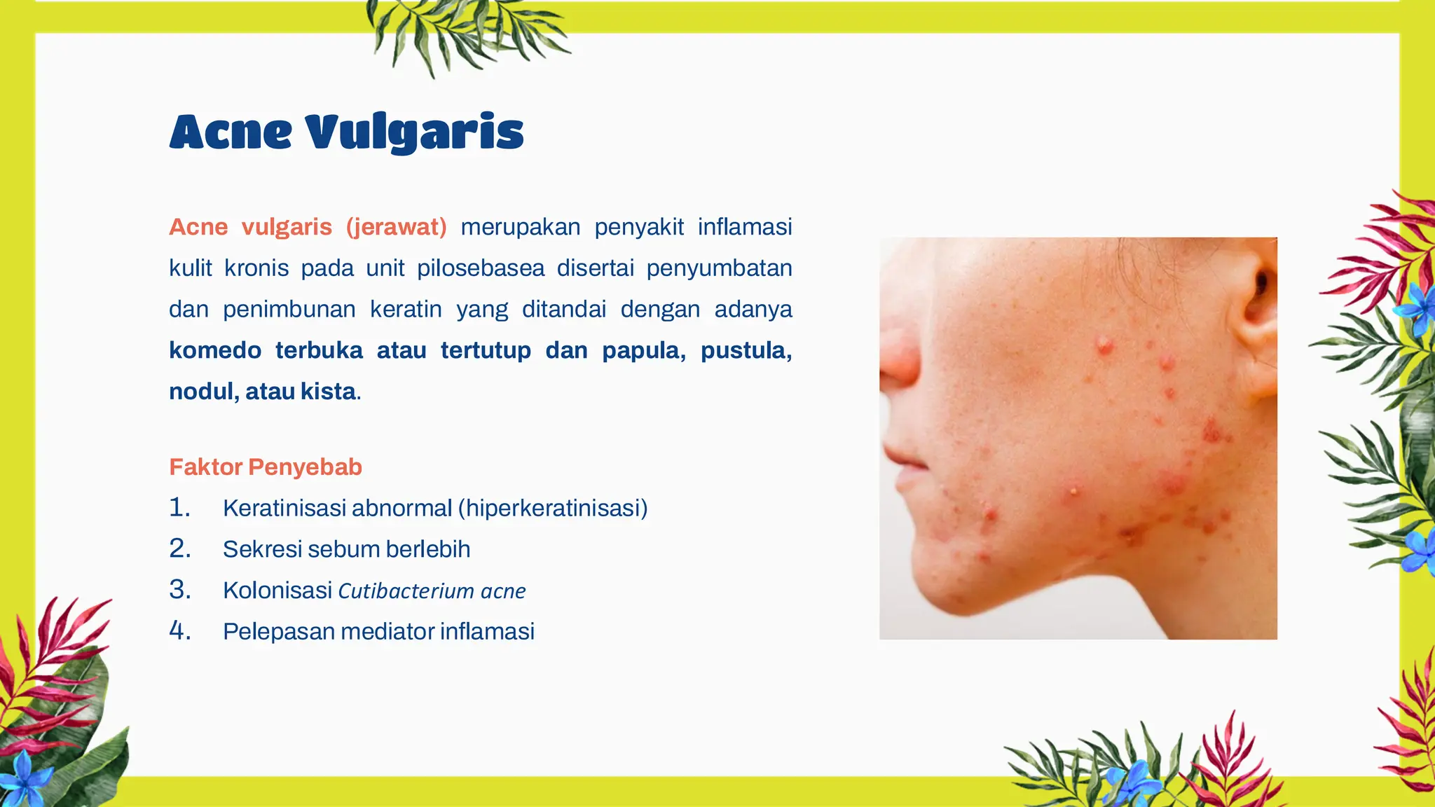 Tatalaksana Acne Vulgaris dengan Terapi Kombinasi | PDF