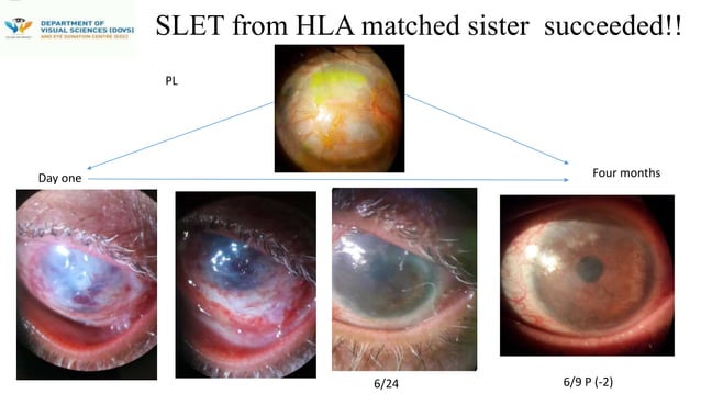 Slet In Bilateral Limbal Stem Cell Deficiency From Hla Matched Sibling ...