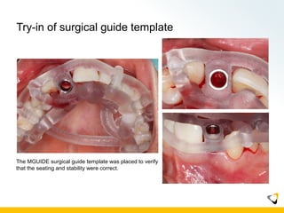 CS3600 Implant Case Presentation | PPT