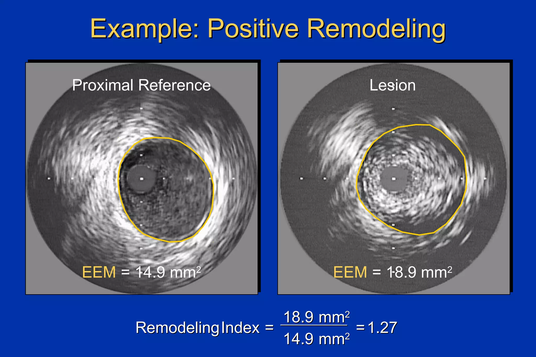 Arterial remodeling in st vs. unst coronary synd schoenhagen1 | PPT ...