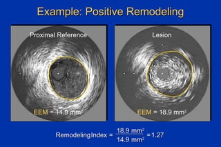 Arterial remodeling in st vs. unst coronary synd schoenhagen1 | PPT