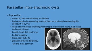 Arachnoid Cyst