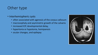178 arachnoid cysts | PPTX