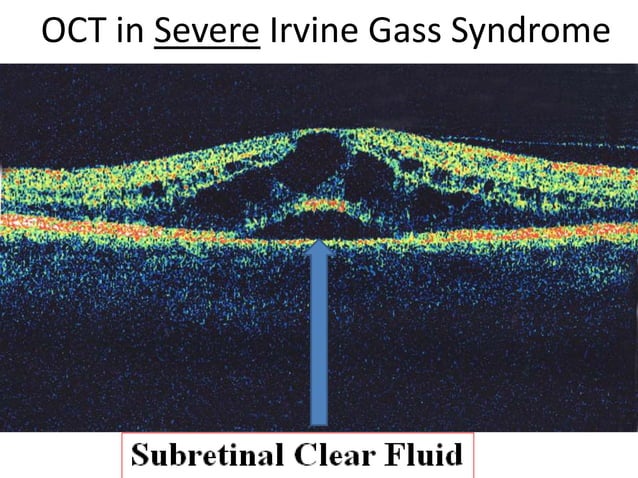irvine gass syndrome | PPT